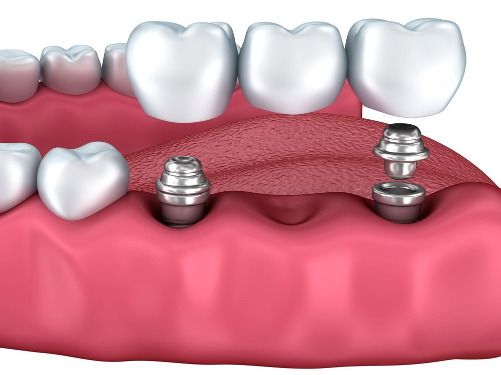 Multiple dental implants | Higgins & Winter clinic | Newcastle