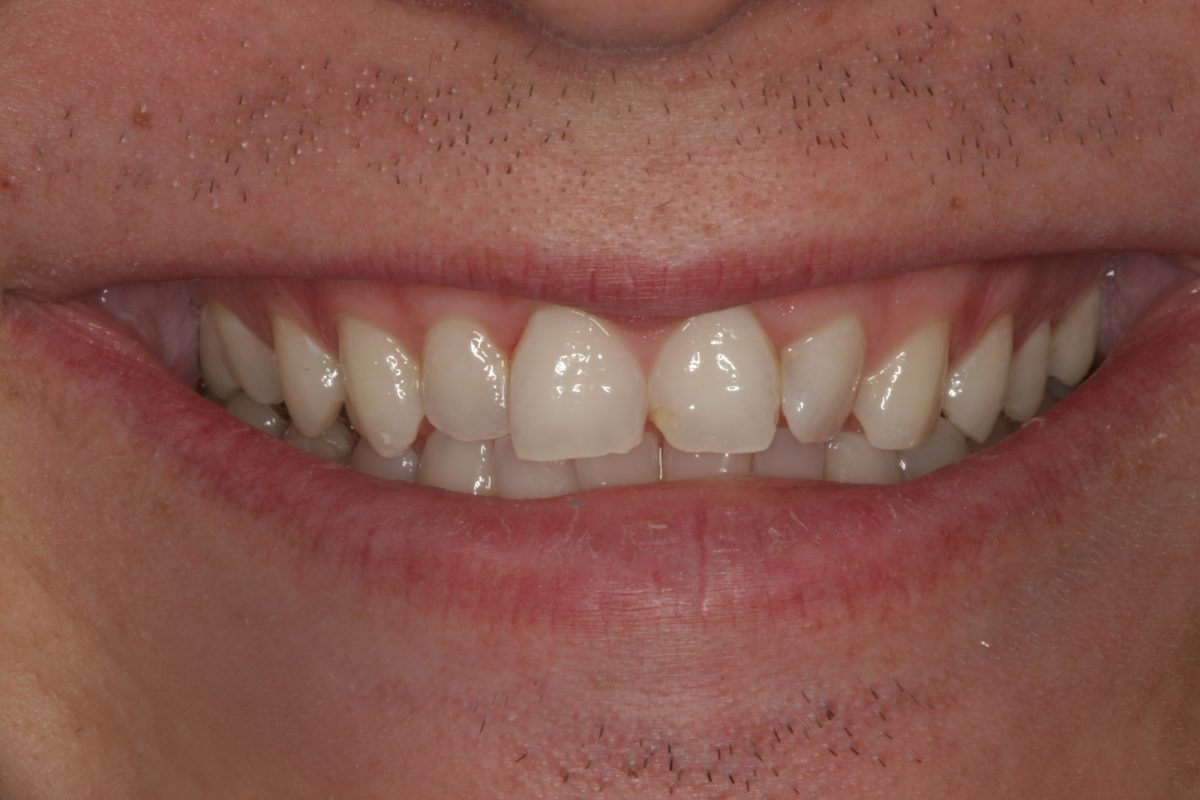 Gappy Smiles | The Smile Spa