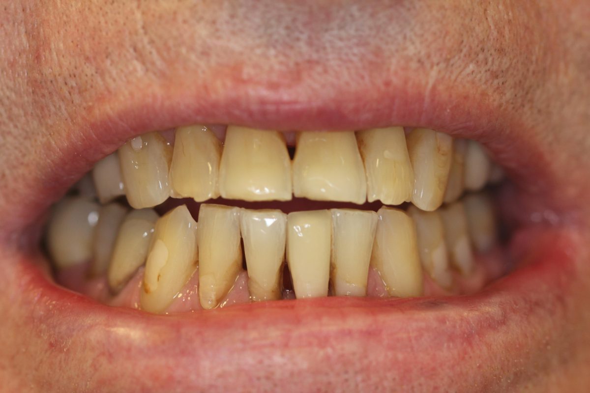 Broken and Chipped Teeth | The Smile Spa