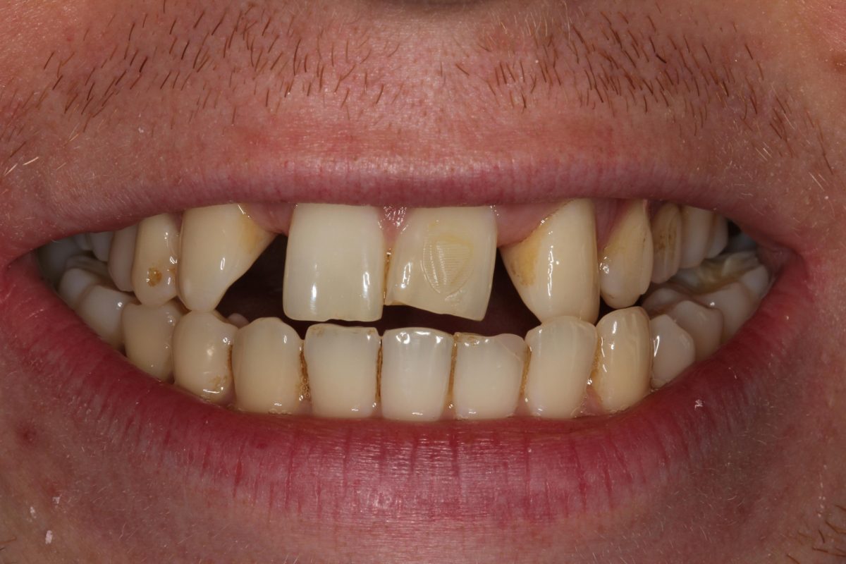 Gappy Smiles | The Smile Spa