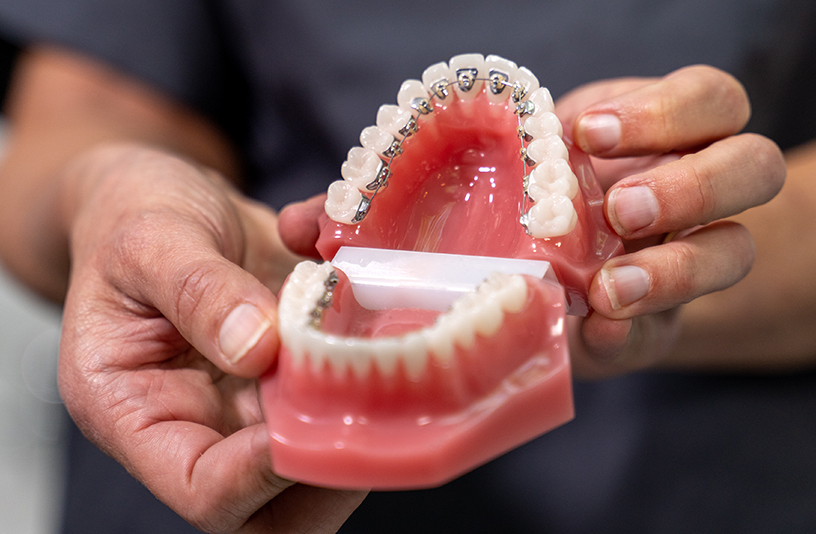 Clear braces | Orthodontic Treatments | Pittville Lawn Dental & Implant ...