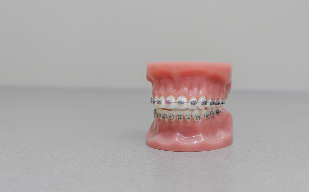 Maidenhead Orthodontics - Portman Dental & Implant Clinic